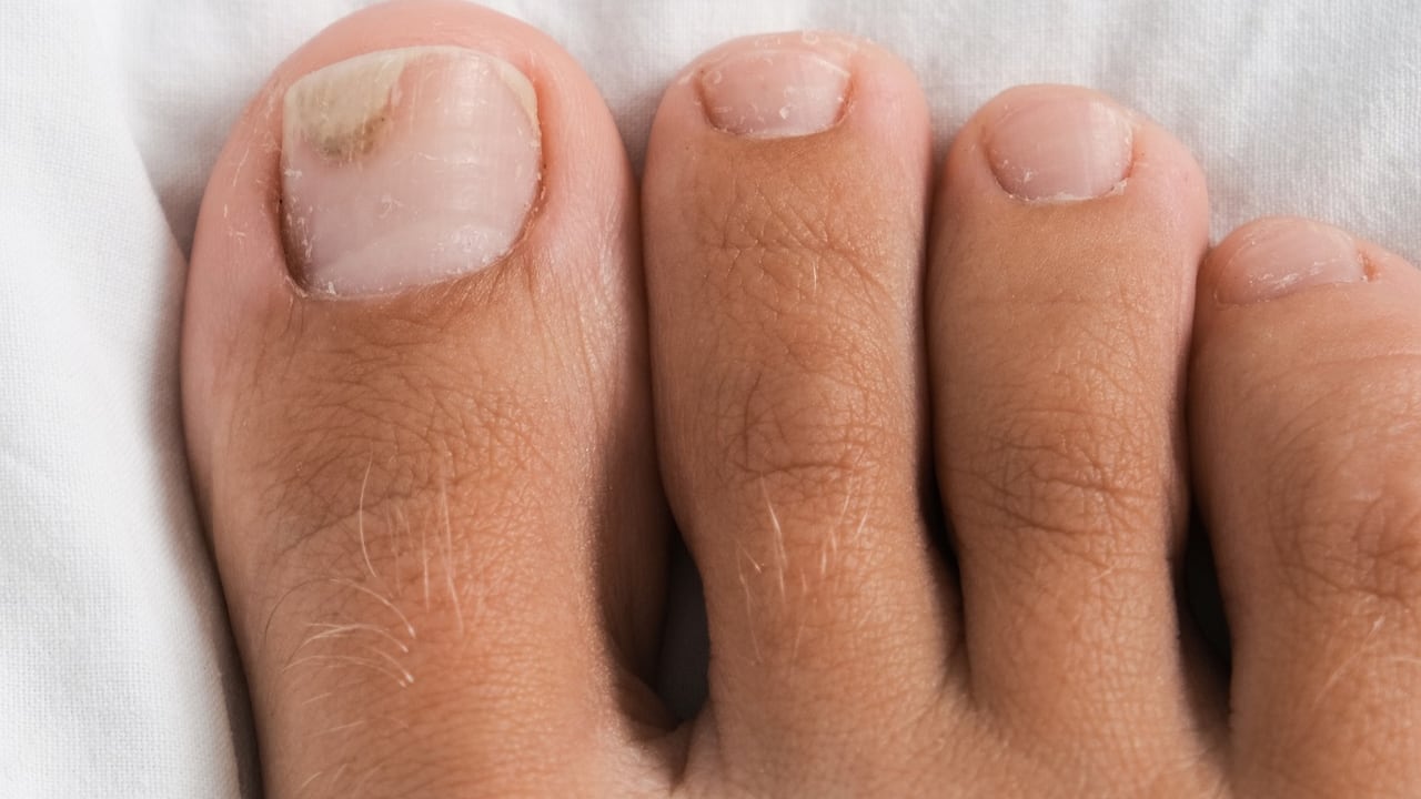 ¿Cómo eliminar hongos de los pies con mezcla casera efectiva? - Diario ...
